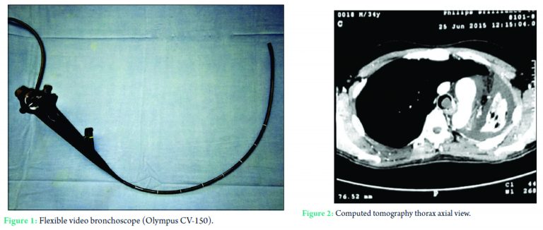 A novel technique for flexible video bronchoscope-guided double-lumen ...