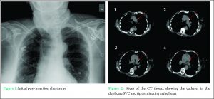 SVC Duplication: The case of the erroneous catheter tip | Journal of ...