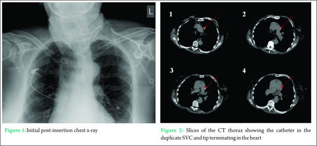 SVC Duplication: The case of the erroneous catheter tip | Journal of ...