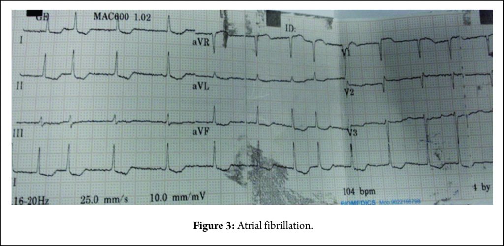 Combined lumbar and sacral plexus block in geriatric high-risk patients ...