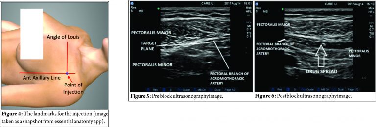 Peripheral nerve stimulator guided pectoralis (PEC-I) block: A novel ...